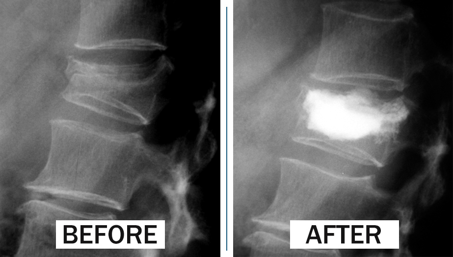 Kypho_BeforeAfter - Cardiovascular Labs of America